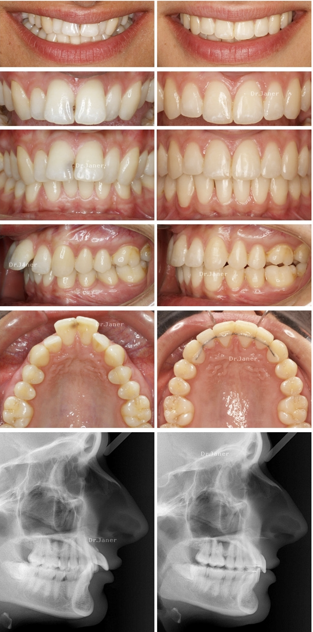 Invisalign Barcelona Corrección con trauma oclusal 8 - Invisalign Barcelona