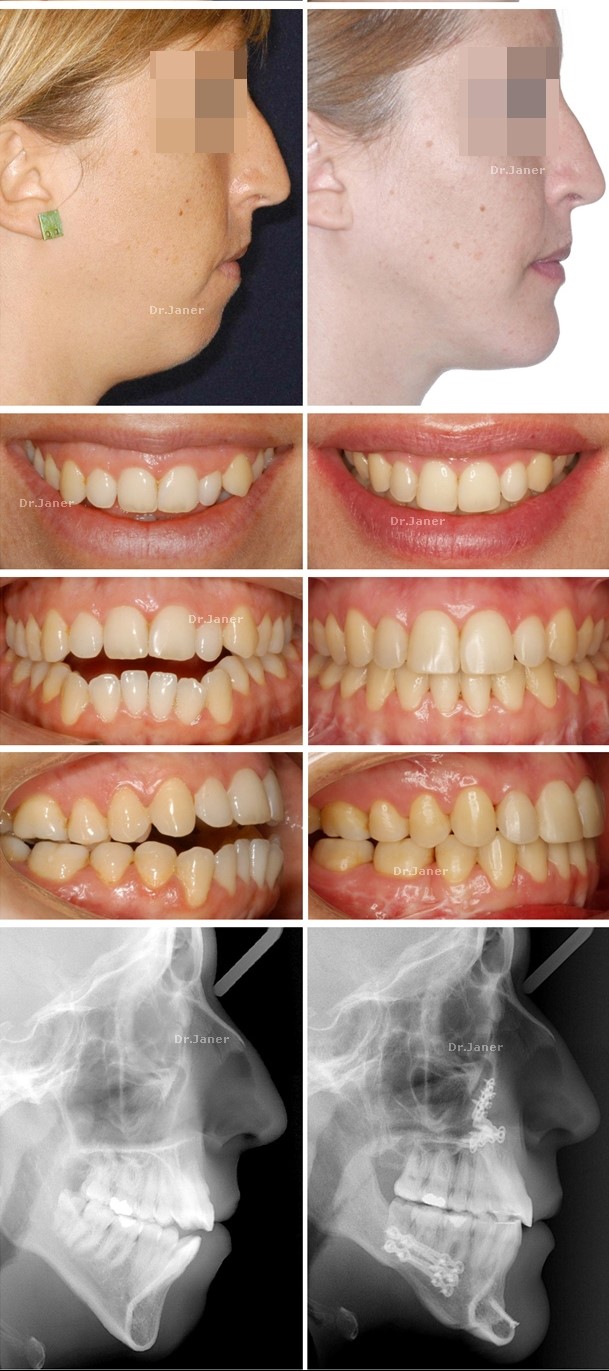 Invisalign Barcelona | Plan Tratamiento Cirugía 10 - Invisalign Barcelona