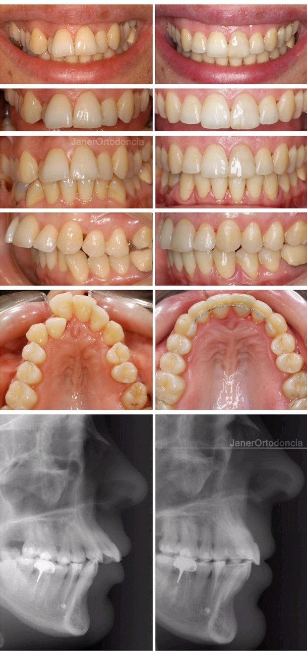 Invisalign Barcelona | Paciente Cirugía 6 - Invisalign Barcelona
