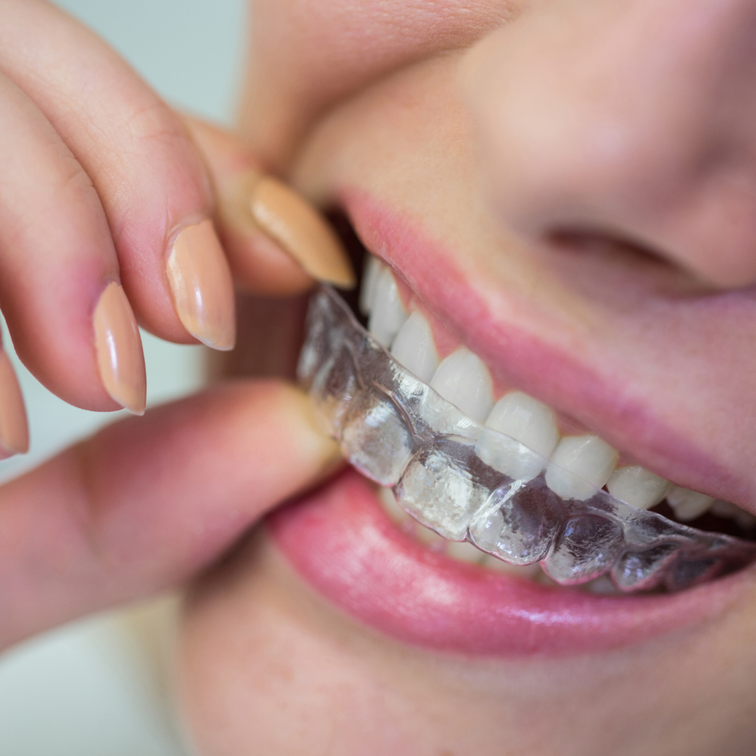 3 Consejos para que tu Invisalign Barcelona sea un éxito
